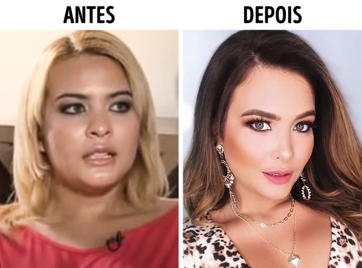Confira O Antes E Depois Das Cirurgias Plásticas De 15 Famosas
