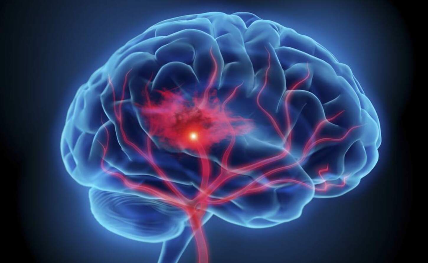 Veja sete maneiras de reduzir a chance de sofrer um AVC - meionorte.com